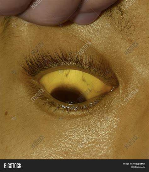 Deep Jaundice Asian Image Photo Free Trial Bigstock