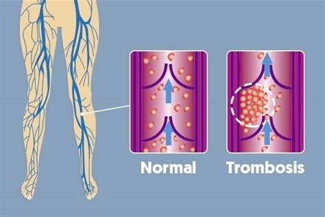 Trombosis qué es síntomas y tratamiento Tua Saúde