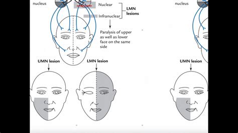 Facial Nerve Lesion