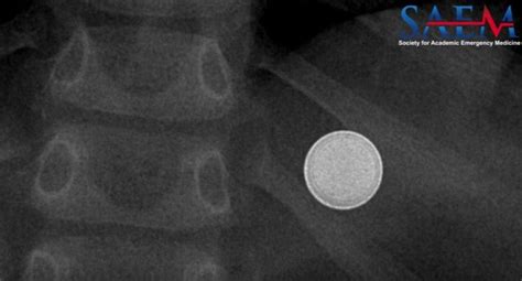 Saem Clinical Image Series Foreign Body Ingestion