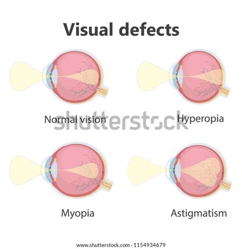Ophthalmic Concept Eye Defects Normal Vision Stock Vector Royalty Free