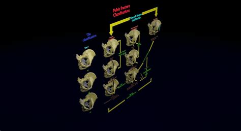 Pelvis Fracture Classifications 3d Model Superhive Formerly Blender