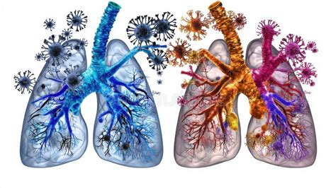 Comparación De Pulmones Y Pulmones Sanos Afectados Por La Tuberculosis
