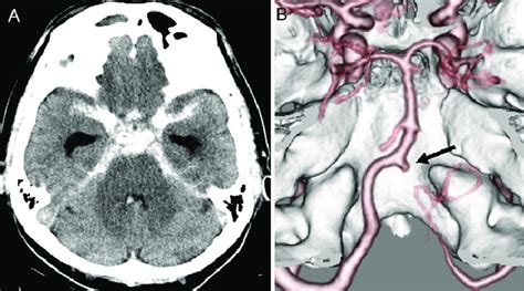 A Initial Noncontrast Axial Computed Tomography CT Scan Showing