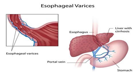 Bleeding Esophageal Varices Official Website