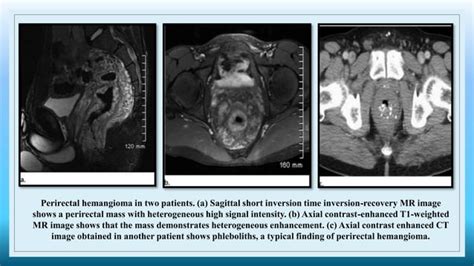 Pre Sacral Lesion Sept5pptx Radiology Pptx Bone And Joint