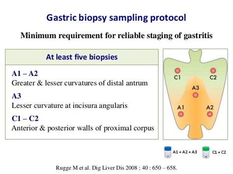 Olga Staging System For Diagnosis Of Gastritis