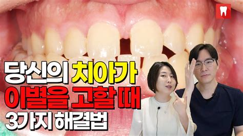 벌어진 앞니 사이 치료는 어떻게 메꾸는지 보여드려요 Youtube