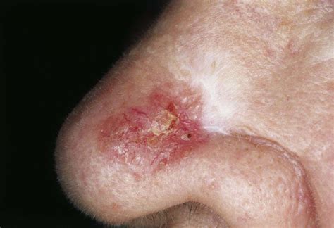 ¿qué Es El Carcinoma Basocelular Y Por Qué Debes Conocerlo Clínica
