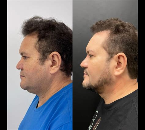 Foto Antes E Depois De Ximbinha Guitarrista Apareceu Completamente