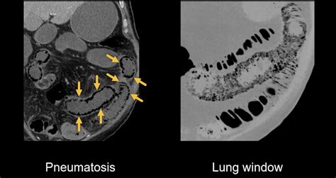 Abdominal Ct Intestinal Ischaemia • Litfl • Radiology Library
