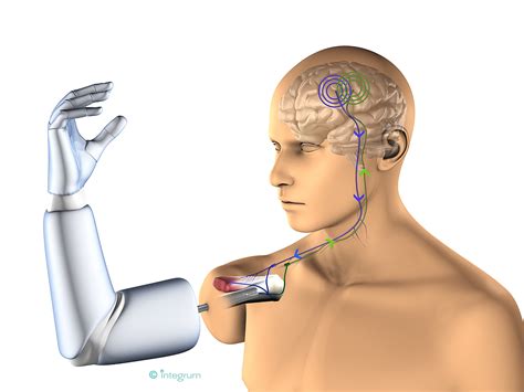 Robotic Human Arm Implantations