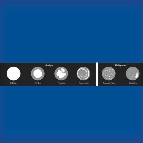 Pulmonary Nodules Common Questions And Answers Aafp