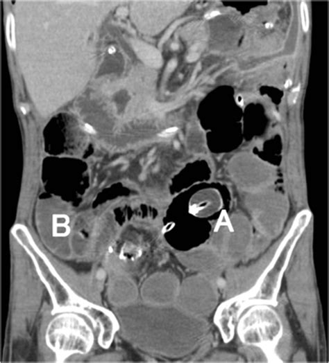 Abdominal Contrast Computed Tomography The Tip Of The Ileus Tube Stops