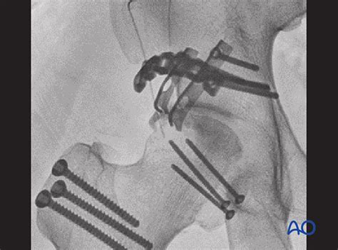Orif For Femoral Head Fractures With Posterior Wall Fracture Of The Acetabulum