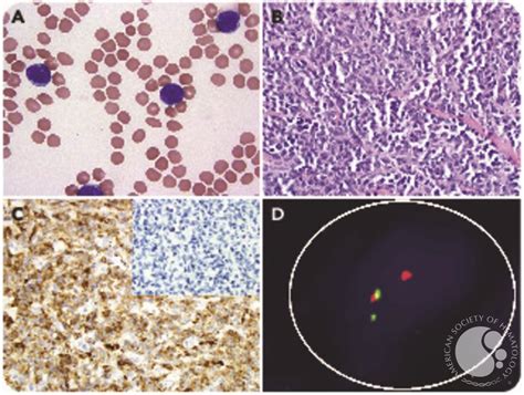 Extramedullary Relapse Of Kmt2amll Rearranged Acute Lymphoblastic