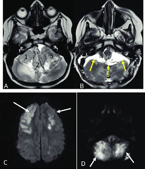 Preoperative And Postoperative Images A Axial T2 Sequence Magnetic
