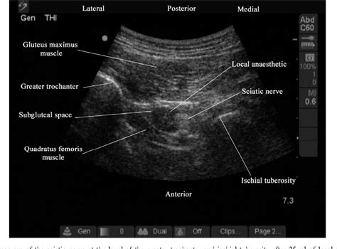 New Approach Of Ultrasoundguided Genitofemoral Nerve Genitofemoral