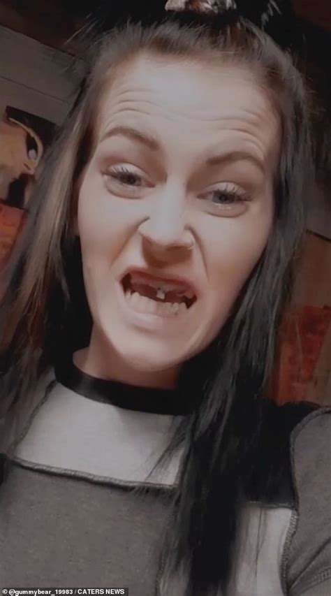 I Was Forced To Get Dentures At Just 23 When My Teeth Unexpectedly