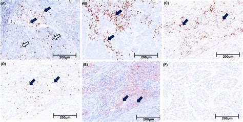 Representative Pathological View Of Immunohistochemistry A Tumoral