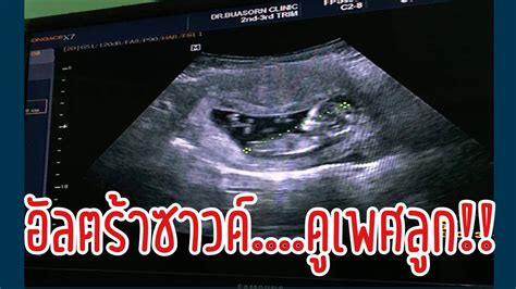 การอัลตร้าซาวด์ดูเพศลูก ลุ้นเพศลูกผู้ชายหรือผู้หญิง อัลตาร์ซาวด์ดู