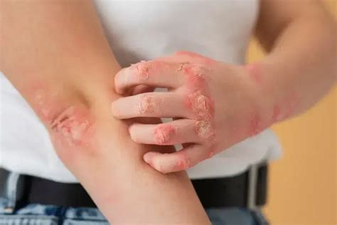 How To Get Rid Of Chilblains Quickly 12 Home Remedies Try Credihealth