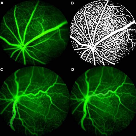 Phases Of Retinal Vascular Development And Abnormal Vascularization