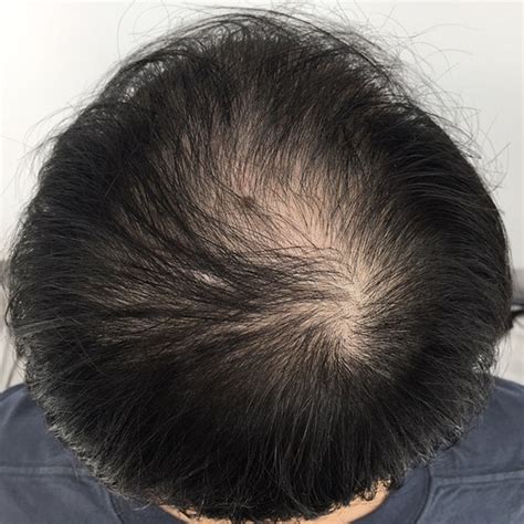 정수리 탈모 어떻게 치료해야 할까요