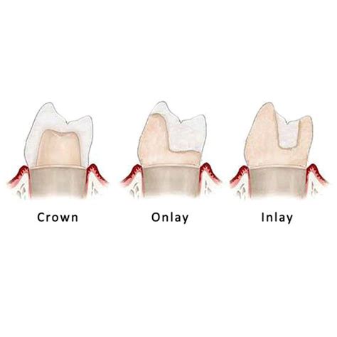 Onlays Restore The Area Inside The Cusp And Extend Over One Or More