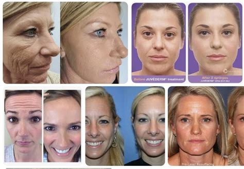Chin Botox Before And After Guide