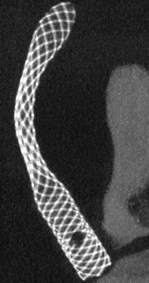 Vertebral Fusiform Aneurysm Pipeline Shield Embolization — Analysis Of Metal Coverage Density