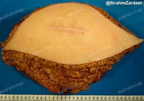 Myxoid Liposarcoma Clinical Features