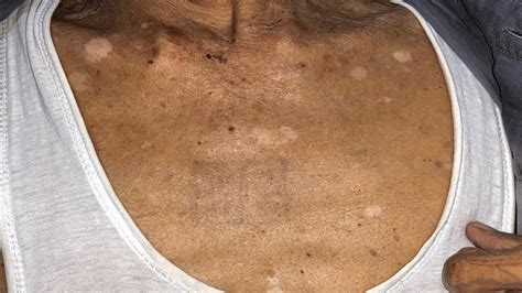 Liver Spots Causes Symptoms Treatments And More