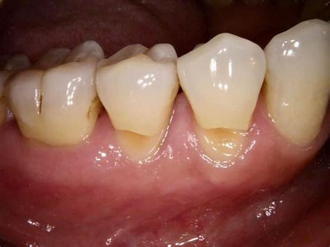 عن طب الأسنان Aboutdent On Twitter Management Of Abfraction Lesions