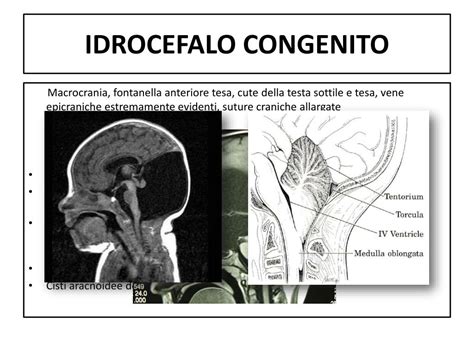 Ppt Idrocefalo Powerpoint Presentation Free Download Id1330850