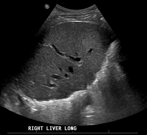 normal early transplant liver ultrasound radiology article