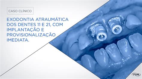 Caso Cl Nico Exodontia Atraum Tica Dos Dentes E Implante E
