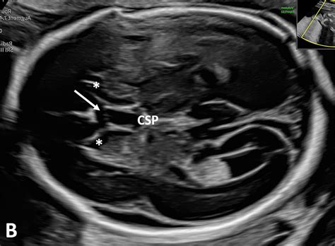 Ultrasound Evaluation Of The Fetal Brain Article Glowm