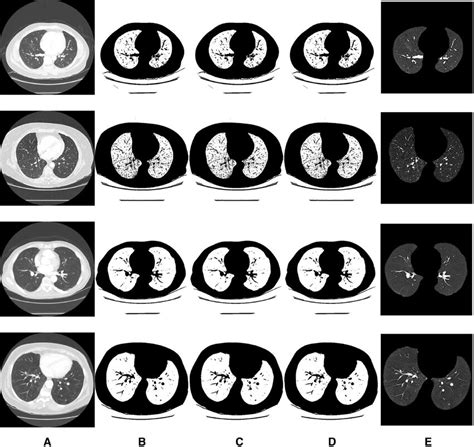 Segmentation Of Lung Parenchyma In Thoracic Ct Image Using Optimization Download Scientific