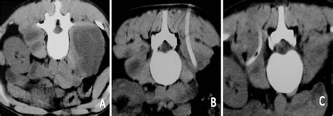 A The Bilateral Psoas Abscess Cavities Were Observed In The Process