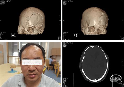 低温保存自体颅骨修补的临床应用 脑医汇