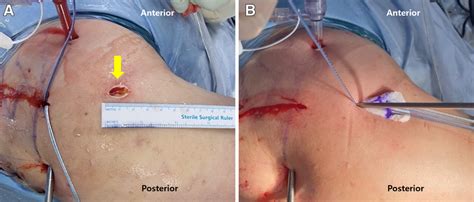 Graft Shuttling Into The Subacromial Space Of The Right Shoulder In The Download Scientific