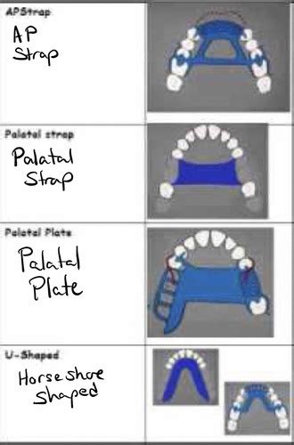 Lecture 1b Removable Partial Denture Components Flashcards Quizlet