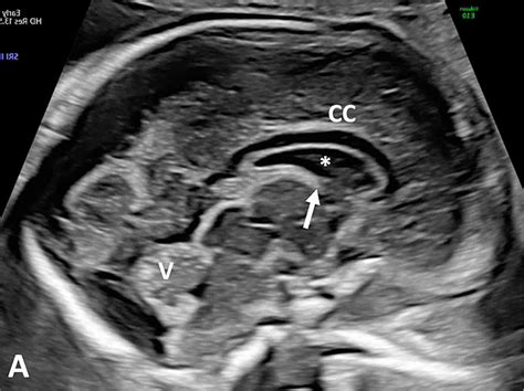 Ultrasound Evaluation Of The Fetal Brain Article Glowm