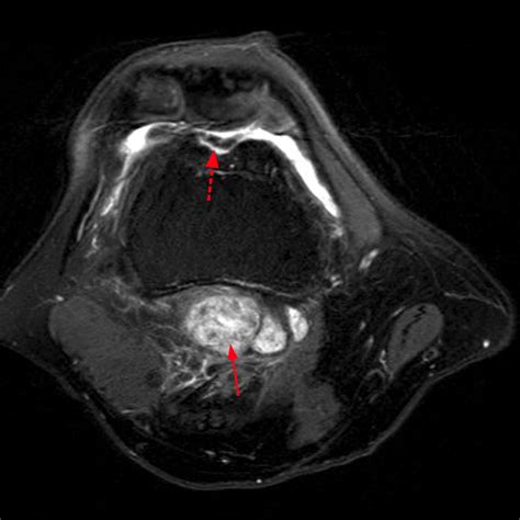 Calcium Pyrophosphate Dihydrate Cppd Crystal Deposition Disease