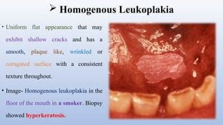 Oral Leukoplakia Pathology Of Gastrointestinal Tractpptx
