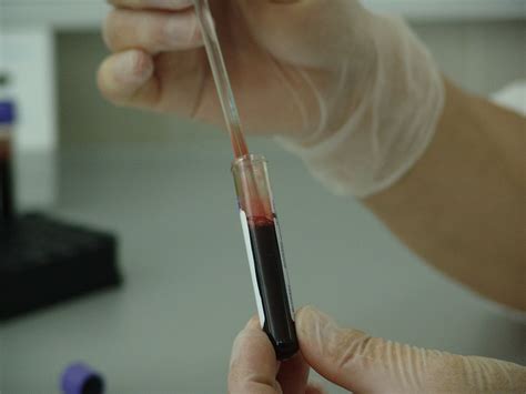 Prueba Experimental De Sangre Detecta 8 Tipos De CÁncer Kuali