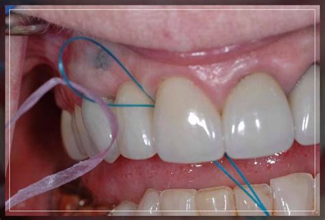 Floss Threader How To Use It Dentist Ahmed Official Website