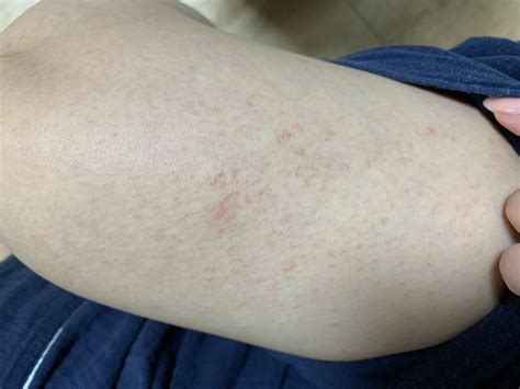 접촉성피부염 지식in