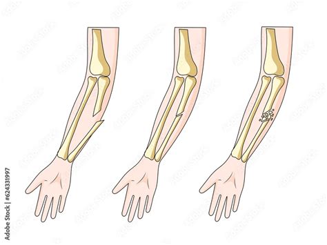 Types Of Hand Bone Fractures Diagram Schematic Raster Illustration
